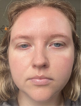 Rosacea Medications | Quick Redness & Flushing Relief | The Red Rescue