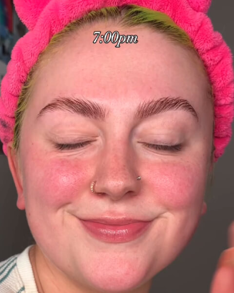 Rosacea Medications | Quick Redness & Flushing Relief | The Red Rescue