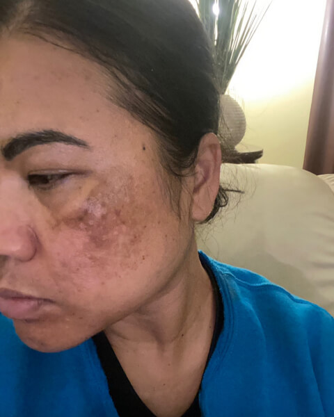 Tranexamic Acid Pills for Melasma | The Spot Pill