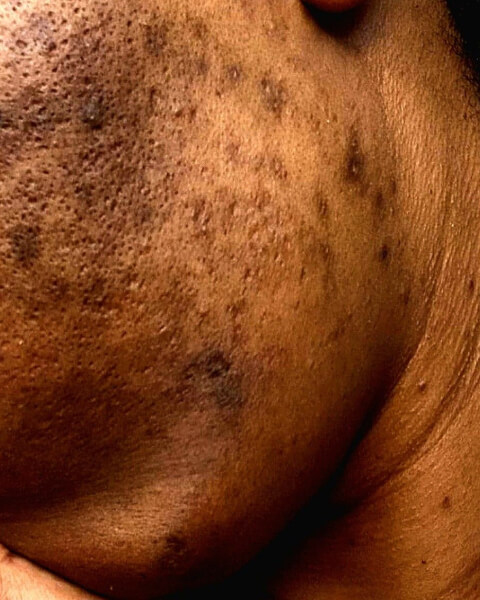 Melasma Treatment | Dark Spot Corrector | Musely Spot Cream