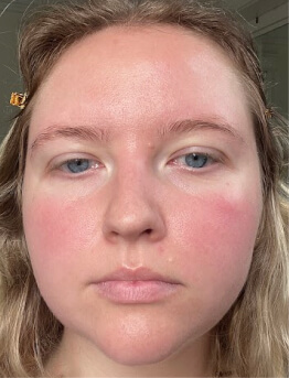 Rosacea Medications | Quick Redness & Flushing Relief | The Red Rescue