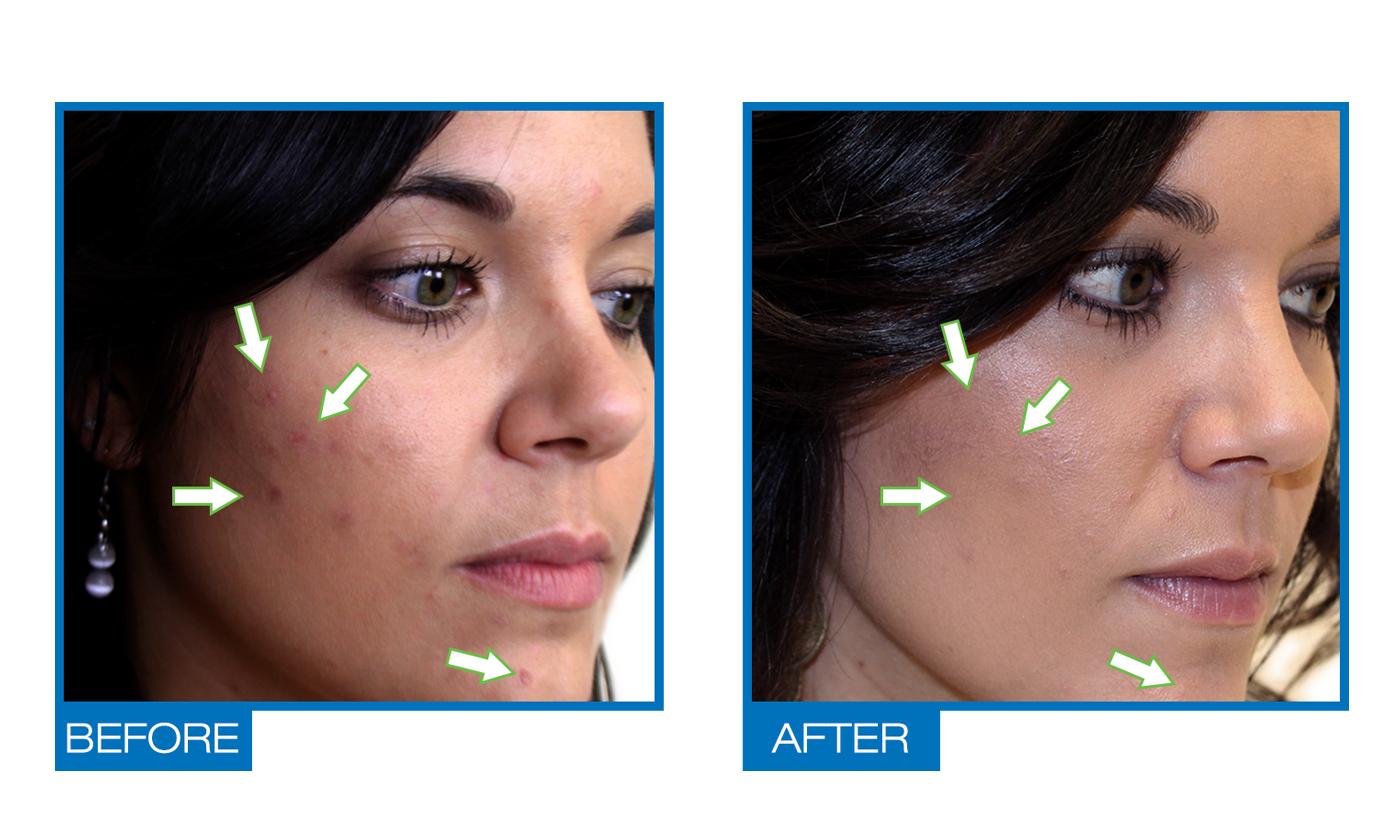 Omiera Labs Acdue Fast Acting Acne, Acne Scars, Blackheads, and Dark ...