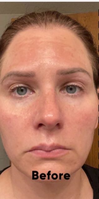 Rosacea Treatment | Facial Hair Removal | Anti-Aging Cream | Musely