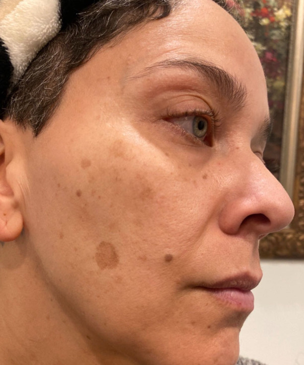 Dark Spot Treatments | Face, Neck & Private Area | Musely