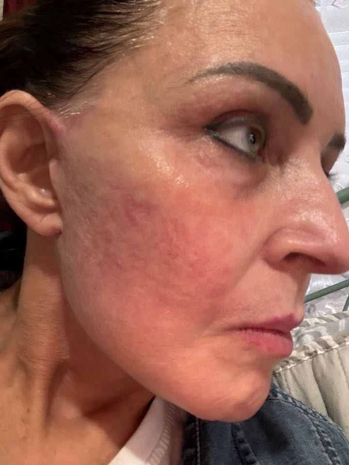 Topical Cream Reviews for Decreasing Redness, Flushing Face & Rosacea ...