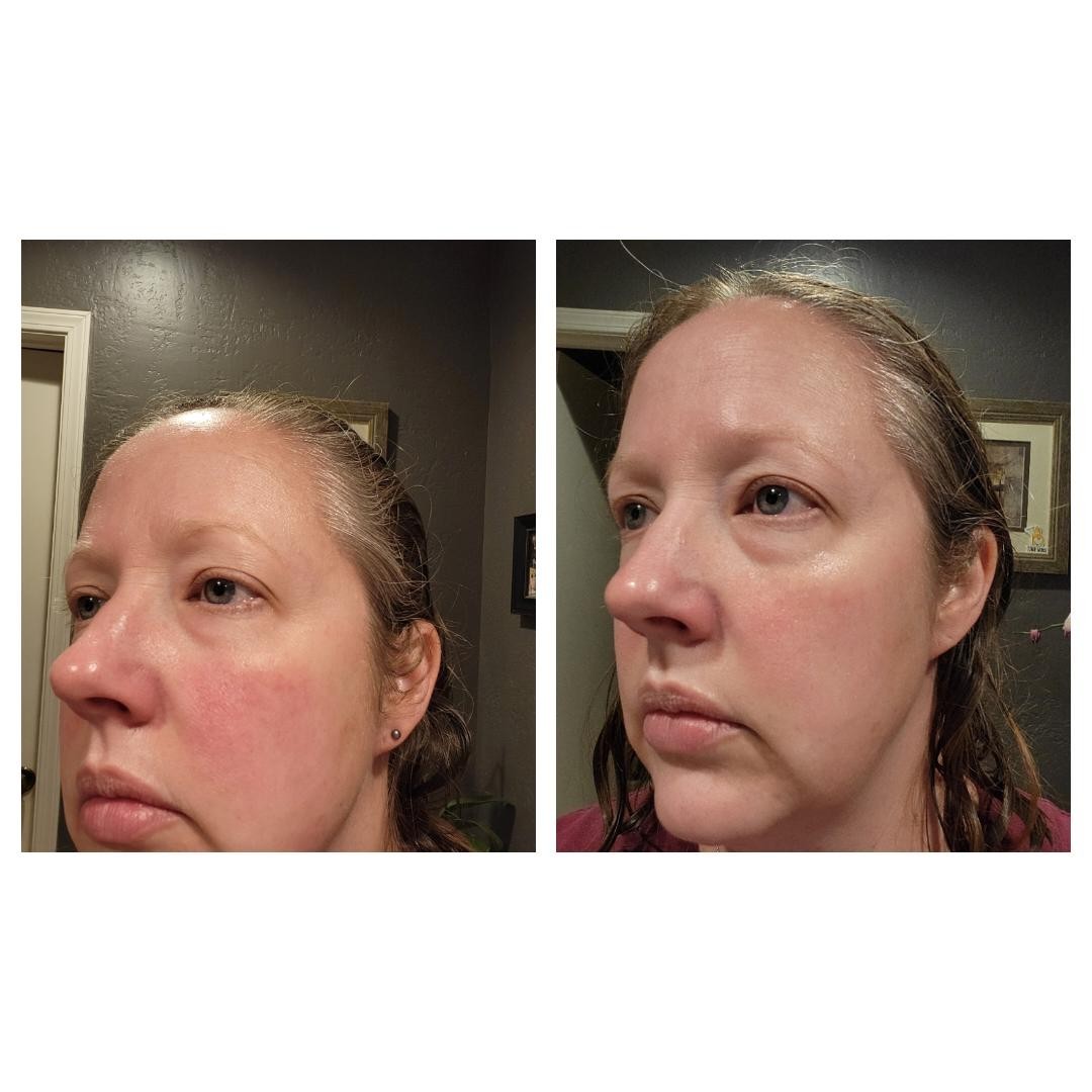 Rosacea Treatment Reviews: Ivermectin And Metronidazole Set