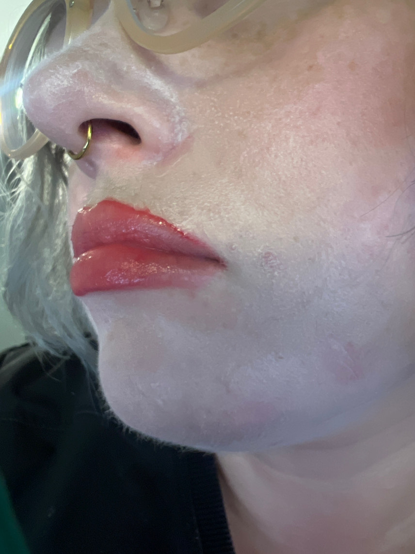 Facial Hair Eflornithine Cream Reviews - Remove Unwanted Facial Hair