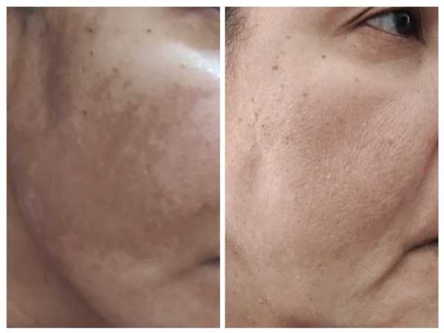 Rosacea Treatments | Skin Treatments For Redness | Musely