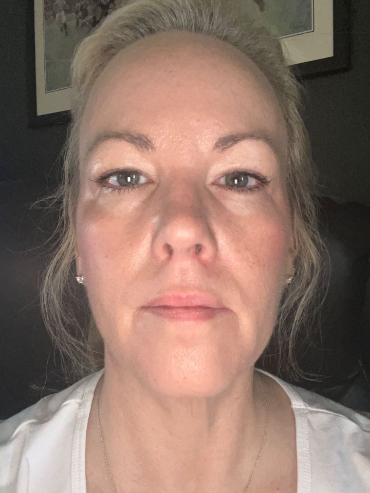 Facial Hair Eflornithine Cream Reviews - Remove Unwanted Facial Hair