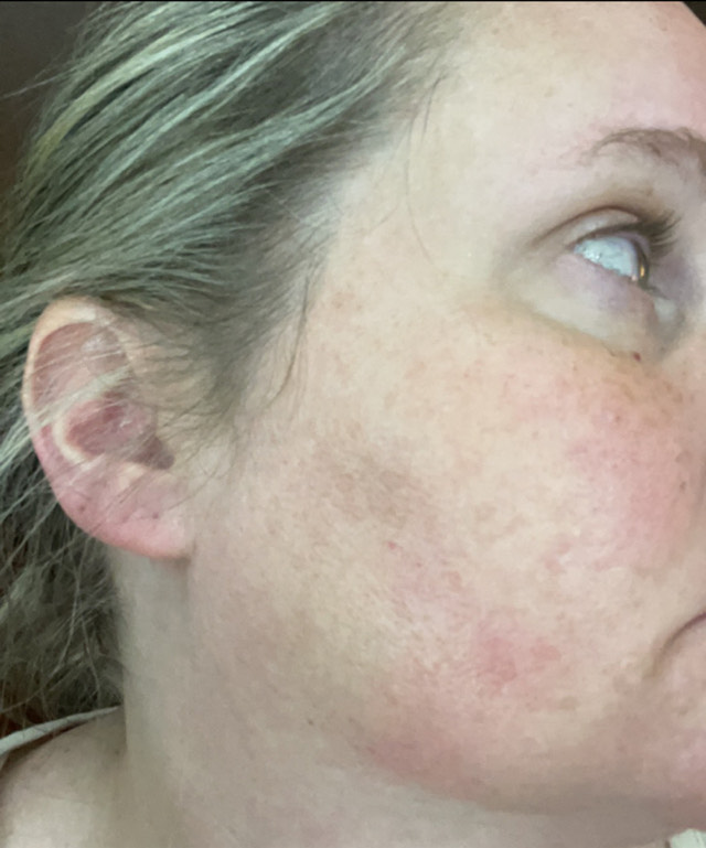 Rosacea Treatments | Skin Treatments For Redness | Musely