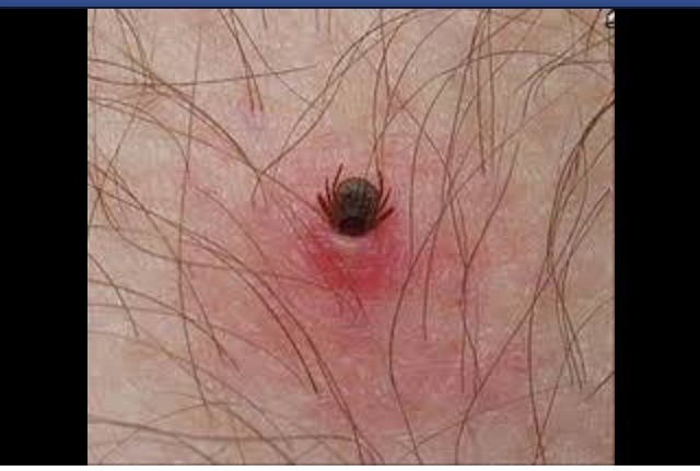 SAFEST EASIEST Way To Get A TICK OUT Musely