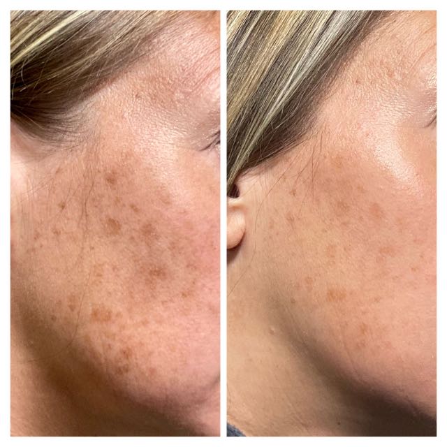 Rosacea Treatments | Skin Treatments For Redness | Musely