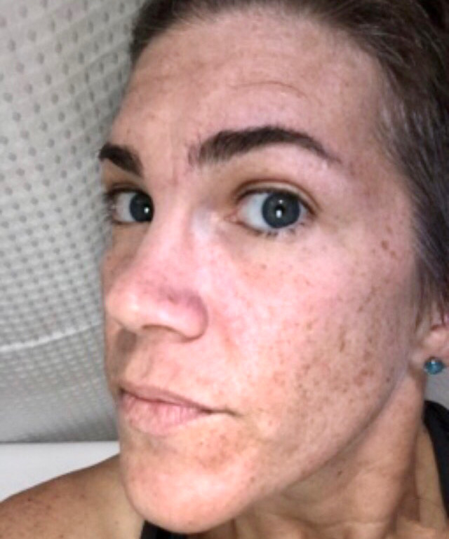 Rosacea Treatments | Skin Treatments For Redness | Musely