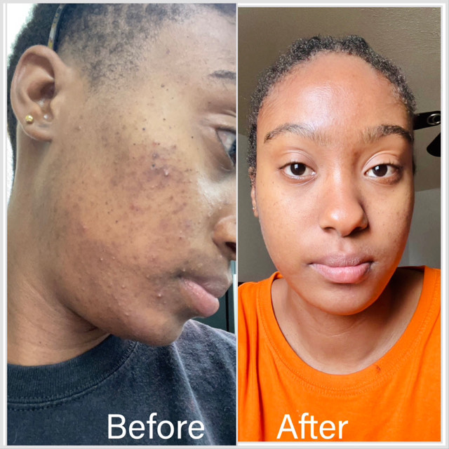 Rosacea Treatments | Skin Treatments For Redness | Musely