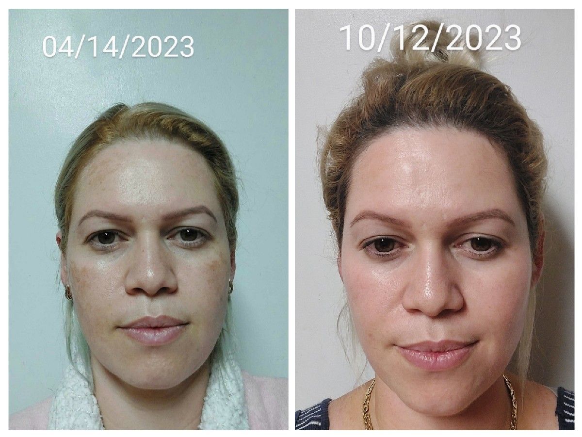 Women's Hair Loss Treatment | Female Pattern Baldness | Musely