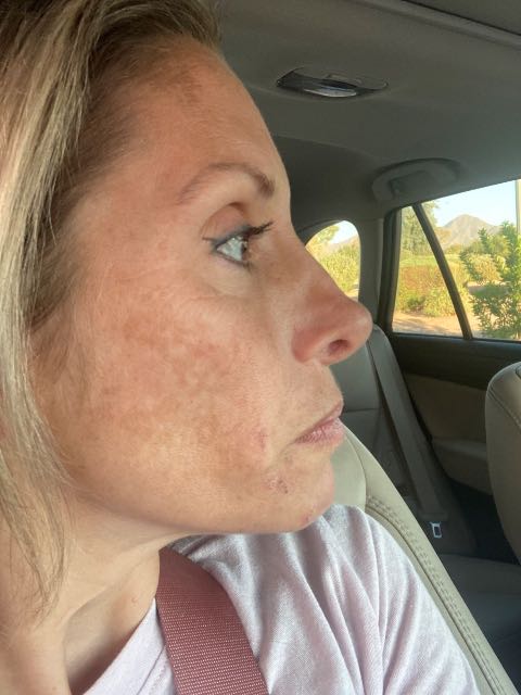 Rosacea Treatment | Facial Hair Removal | Anti-Aging Cream | Musely
