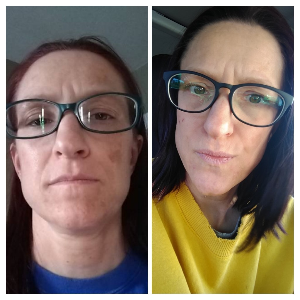 Spot Pill Reviews: Oral Tranexamic Acid Medication for Melasma